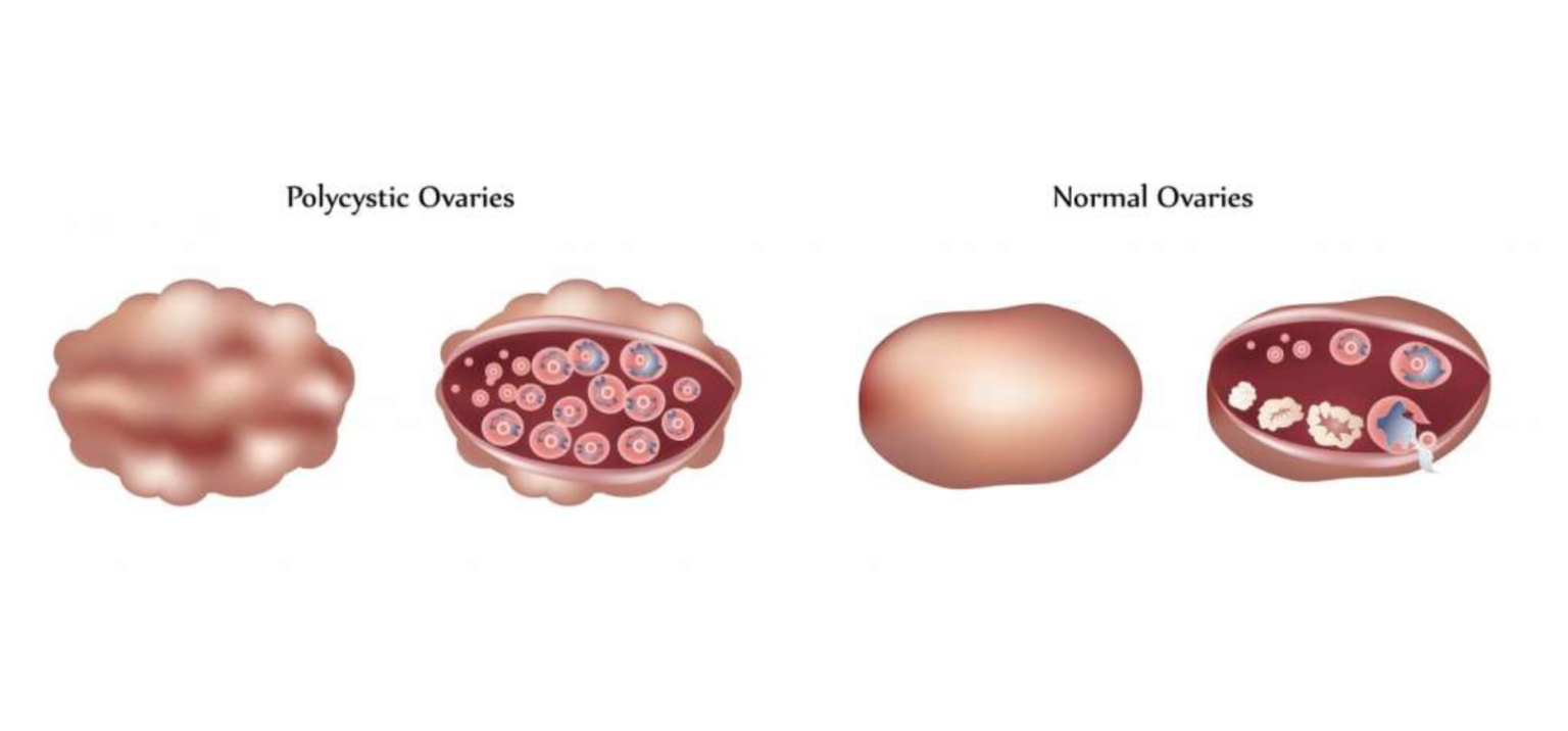 CrossFit | What Causes PCOS?