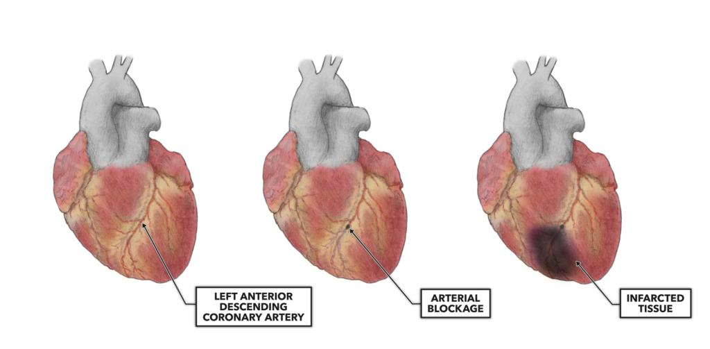 CrossFit | The Heart, Part 10: Myocardial Infarction