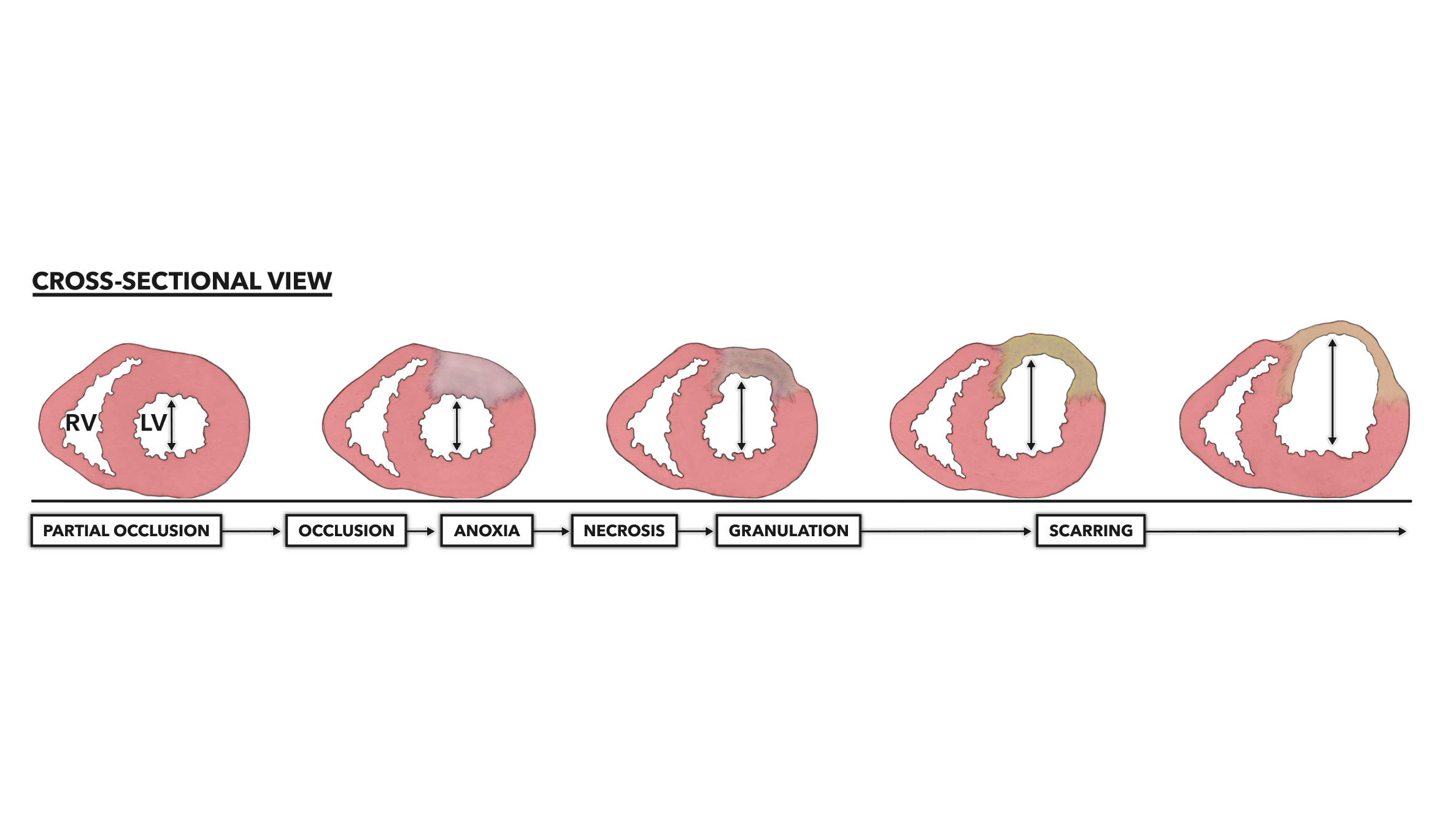 CrossFit | The Heart, Part 11: Myocardial Remodeling and Salvage