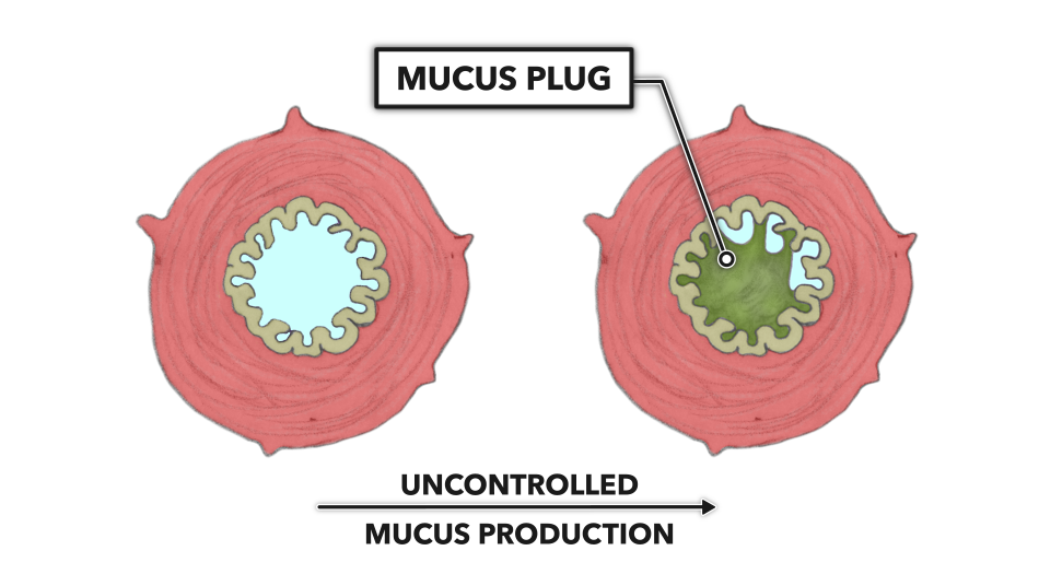 CrossFit | Lung Anatomy and Physiology: Asthma